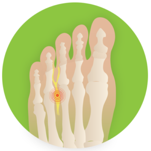 Mortons Neuroma - Orthoquest
